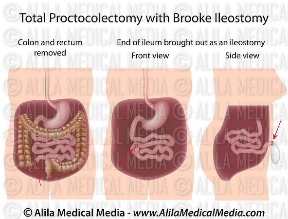 Alila Medical Media | Total Proctocolectomy with Brooke Ileostomy ...