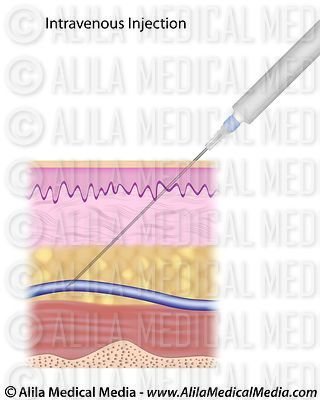 Alila Medical Media | Allergy & Immunology Images & Videos