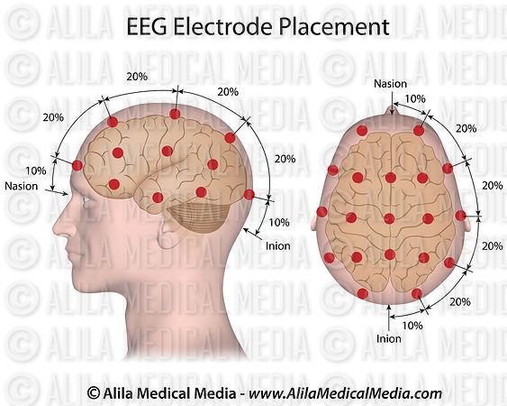 Alila Medical Media | EEG electrode placement | Medical illustration