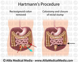 Hartmann's procedure.