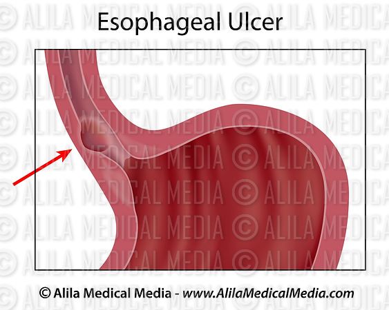 Alila Medical Media | Esophageal ulcer | Medical illustration