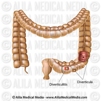 Alila Medical Media | Esophageal endoscopy and cancer diagnosis ...