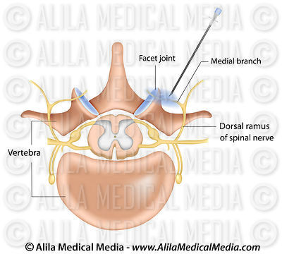 Alila Medical Media | Pain Management Images and Videos
