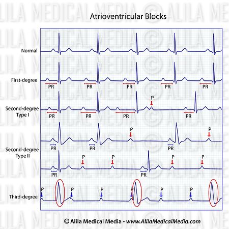 Alila Medical Media | Atrioventricular block (AV block) ECGs | Medical ...