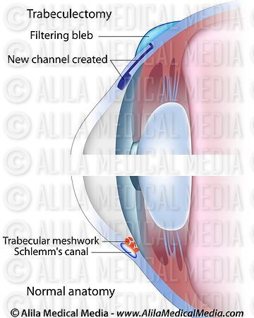 Alila Medical Media | Trabeculectomy | Medical illustration