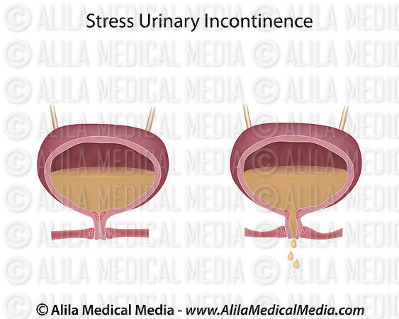 Alila Medical Media | Stress urinary incontinence, unlabeled. | Medical ...