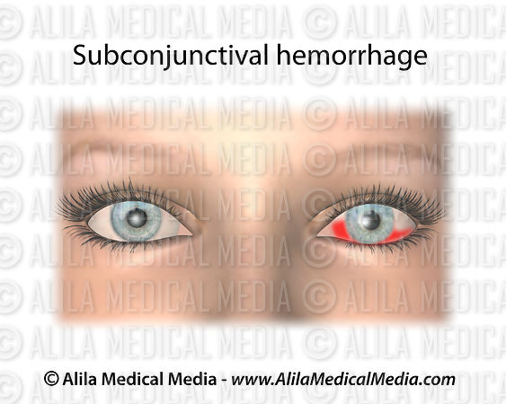 Alila Medical Media | Subconjunctival hemorrhage drawing. | Medical ...