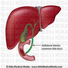 Alila Medical Media | Hartmann's procedure. | Medical illustration