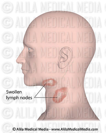 Alila Medical Media | Red swollen lymph nodes in lymphadentis, labeled ...