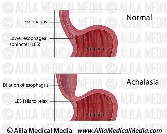 Alila Medical Media | Esophageal achalasia | Medical illustration