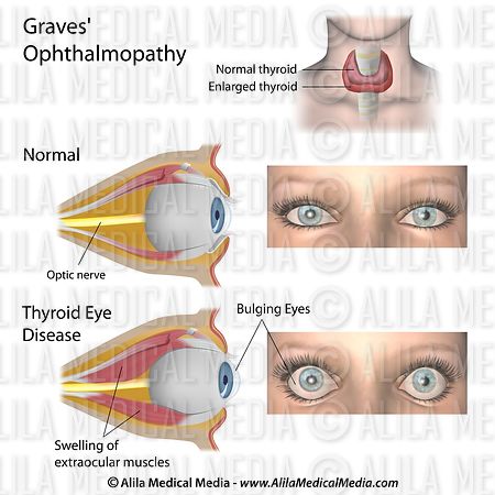 Alila Medical Media | Thyroid eye disease | Medical illustration