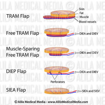 Alila Medical Media | Comparing breast reconstruction surgery ...