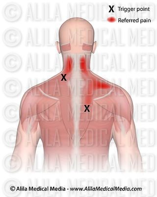 Alila Medical Media | Pain Management Images and Videos