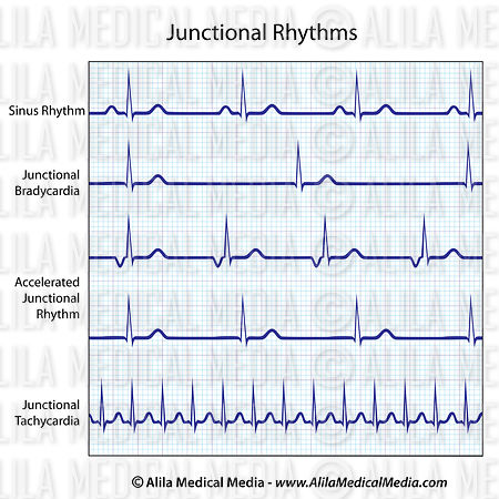 Alila Medical Media | Junctional rhythms ECGs | Medical illustration