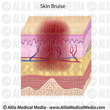 Alila Medical Media | Skin bruise diagram. | Medical illustration