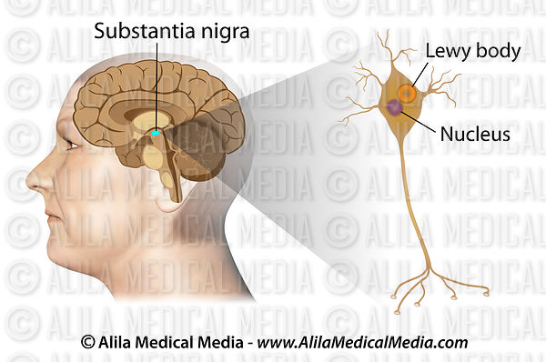 Alila Medical Media | Lewy body in Parkinson's disease, v2 | Medical ...