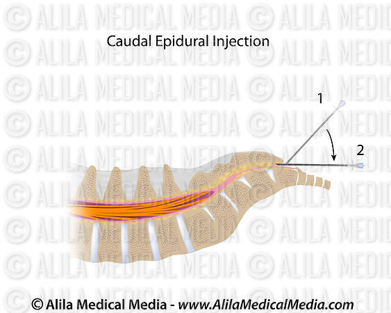 Alila Medical Media | Caudal epidural injection | Medical illustration
