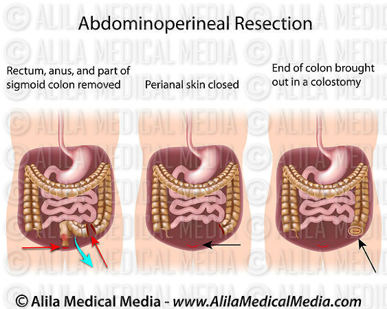 Alila Medical Media | Abdominoperineal resection. | Medical illustration