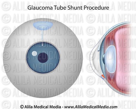 Alila Medical Media | Glaucoma Tube Shunt Procedure. | Medical illustration