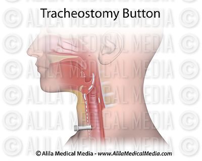 Alila Medical Media | Respiratory System Images