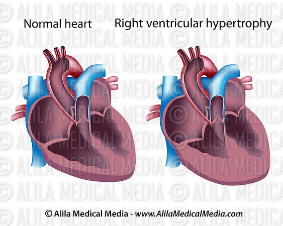 Alila Medical Media | Right ventricular hypertrophy | Medical illustration