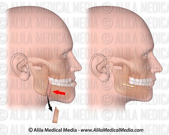 Alila Medical Media | Corrective surgery for protruding lower jaw ...