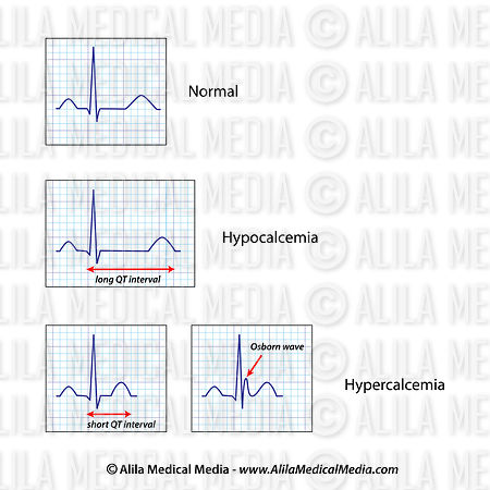 Alila Medical Media | Hypercalcemia and hypocalcemia ECG | Medical ...