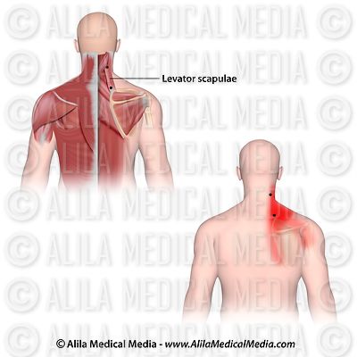 Alila Medical Media | Bones, Joints and Muscles Images