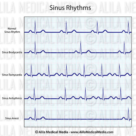 Alila Medical Media | Sinus rhythms ecgs | Medical illustration