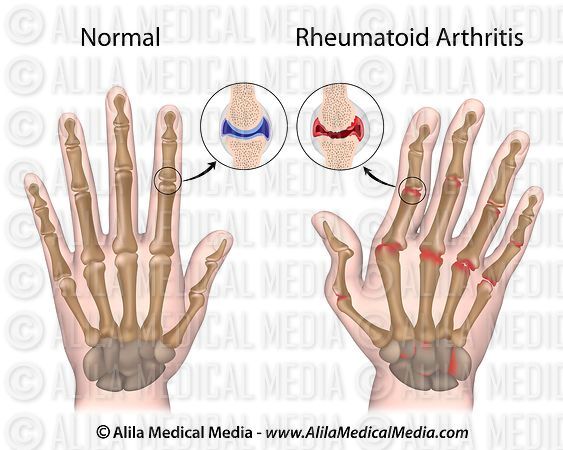 Alila Medical Media | Rheumatoid arthritis of hand | Medical illustration