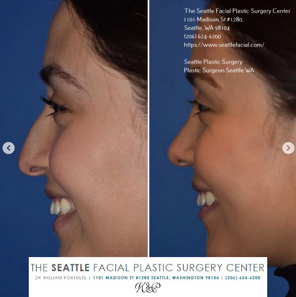 Open Rhinoplasty