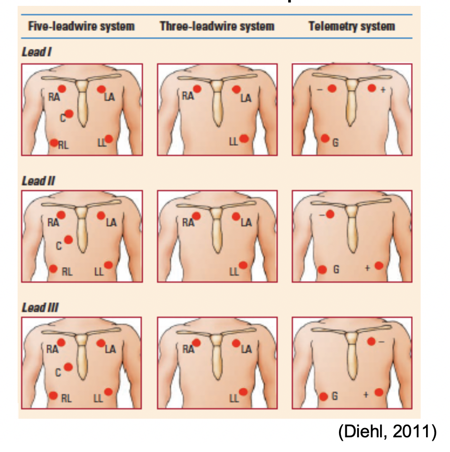 Cardiac Monitor 5 Lead Telemetry Placement Cardiac Monitor 5 Lead Telemetry Placement