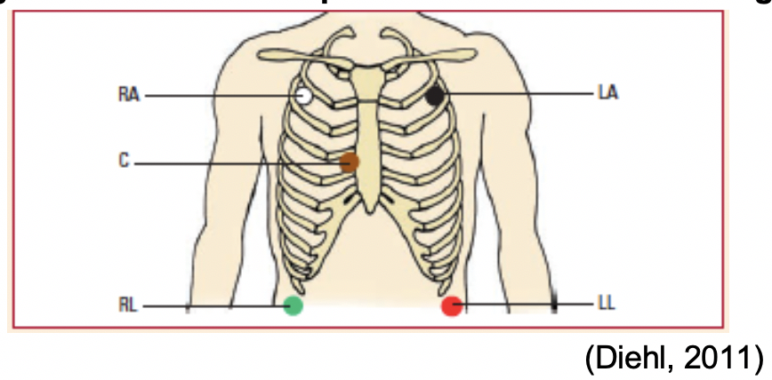 Introduction to Telemetry Monitoring for Arrhythmias Nursing CE Course ...