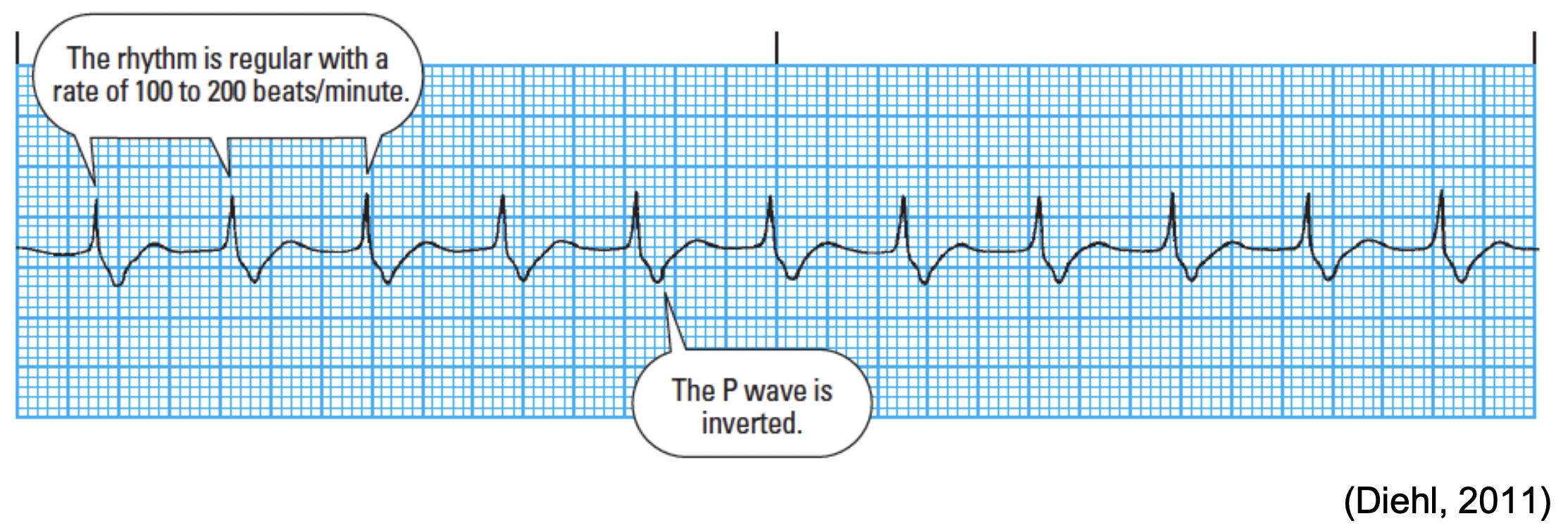 Introduction to Telemetry Monitoring for Arrhythmias Nursing CE Course ...
