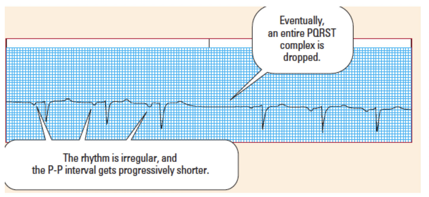 Introduction to Telemetry Monitoring for Arrhythmias Nursing CE Course ...