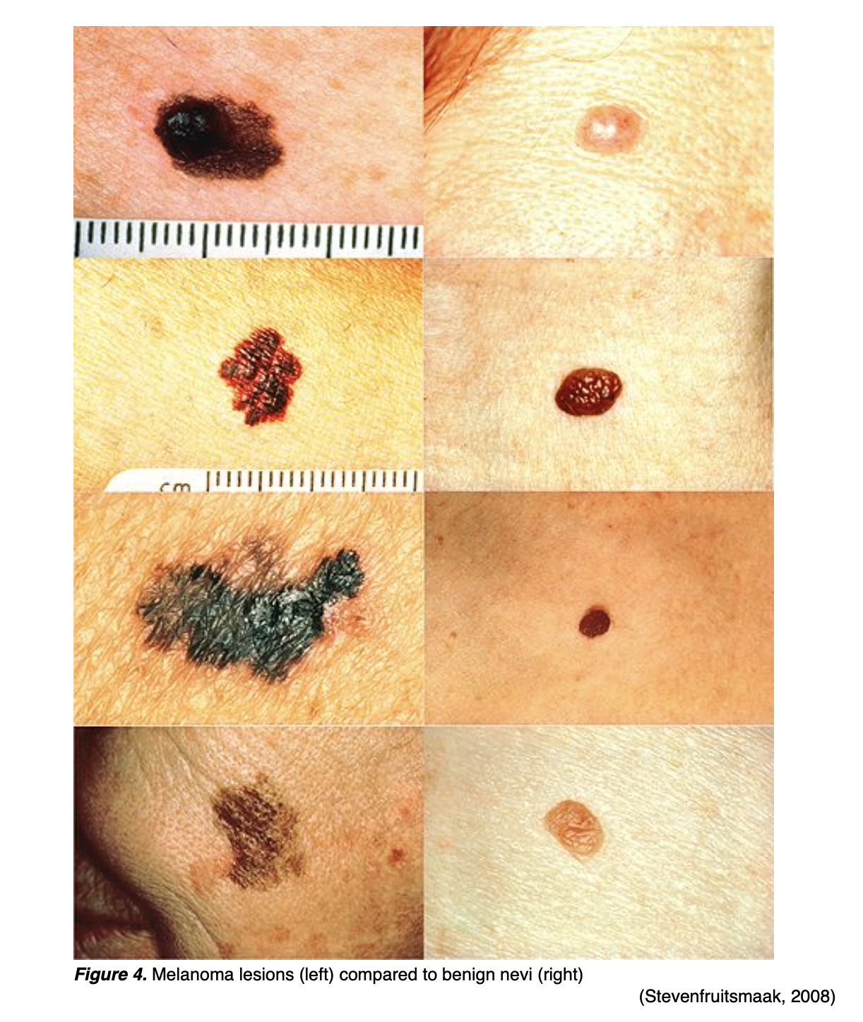 Skin Cancer Nursing CE Course | NursingCE