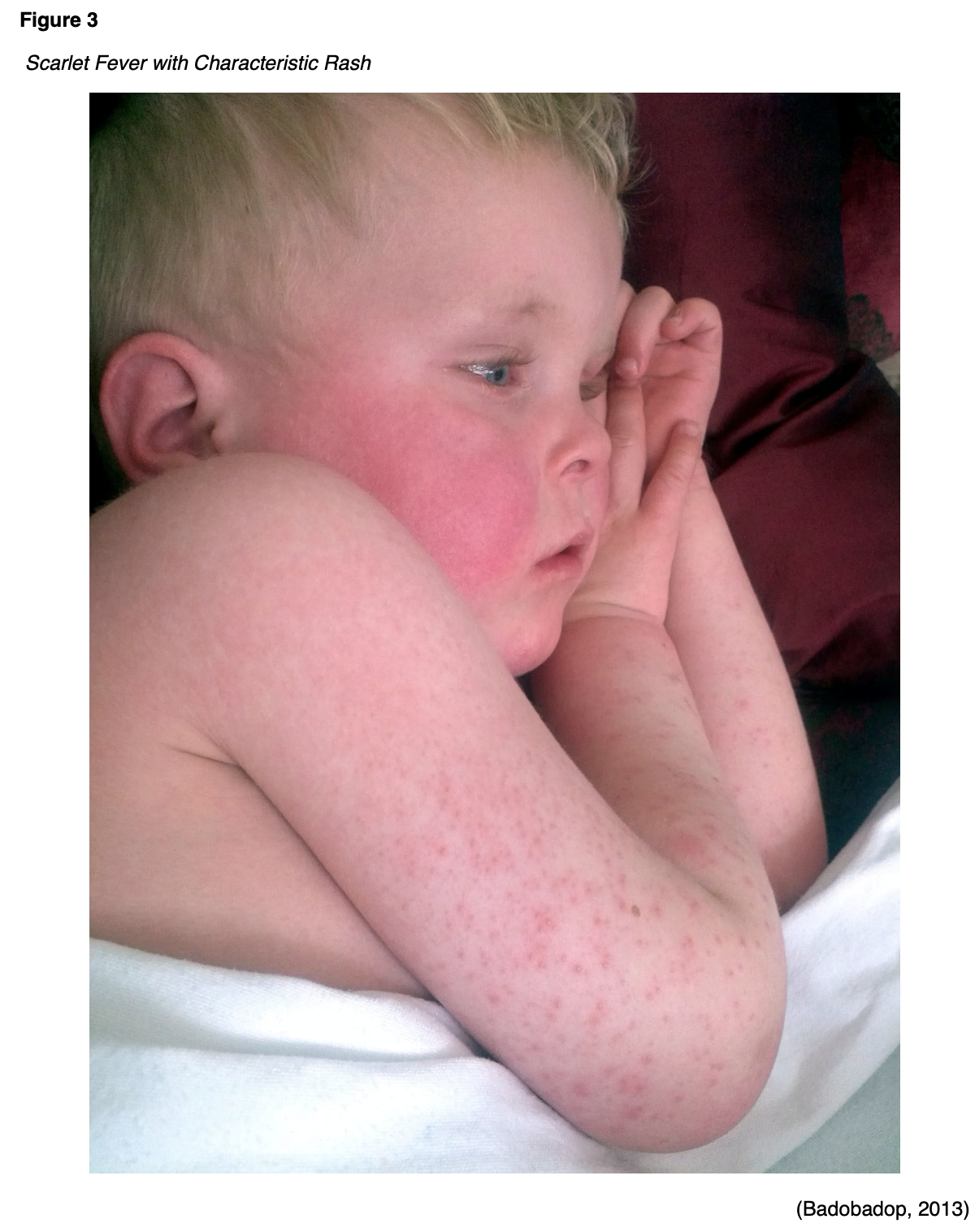 Acute Pharyngitis for APRNs Nursing CE Course | NursingCE