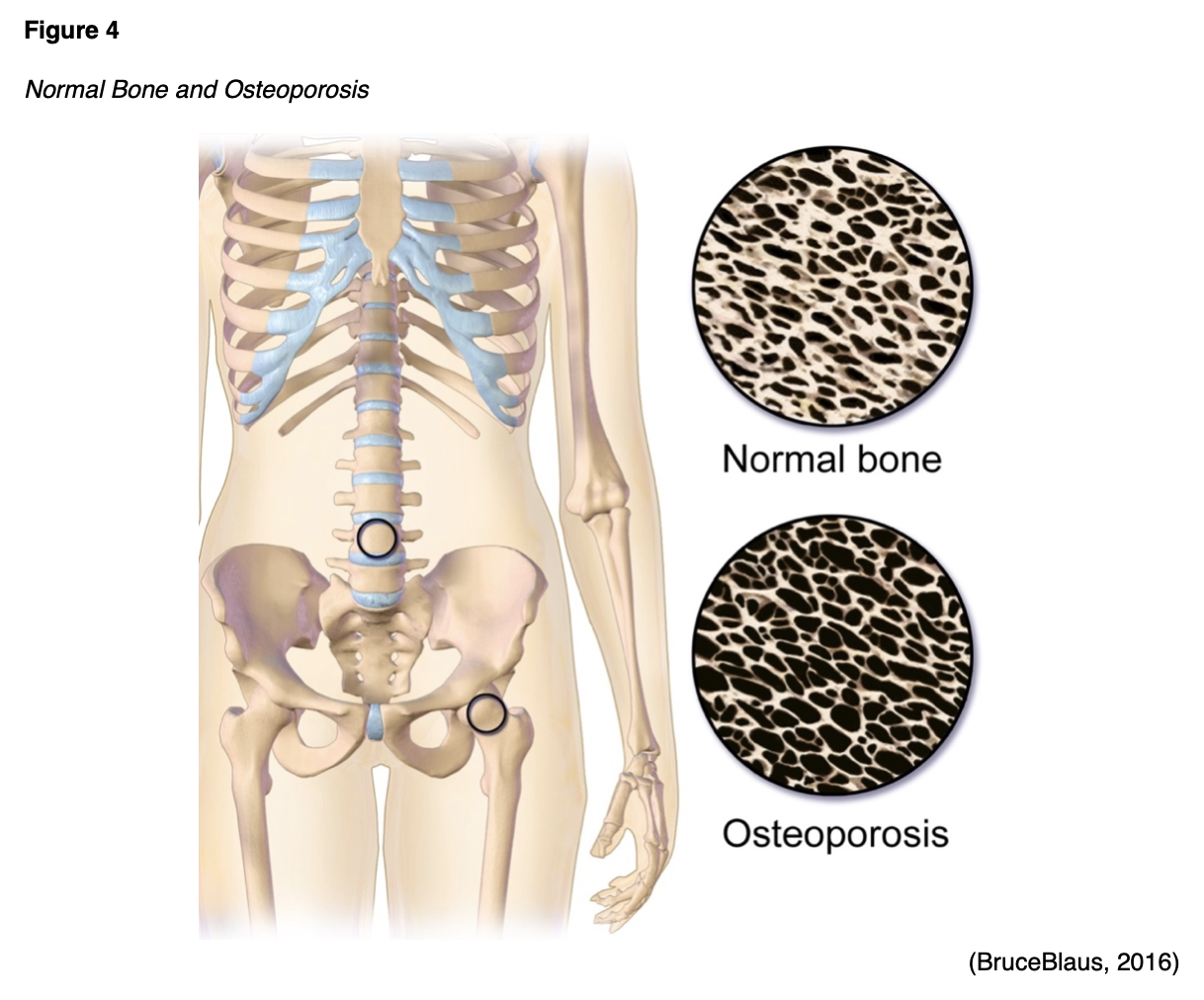 Osteoporosis For Rns And Lpns Nursing Ce Course Nursingce