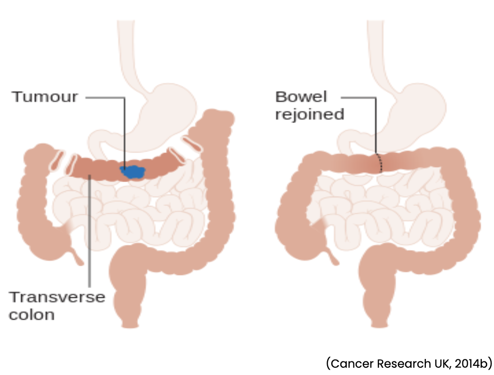 Ostomy Placement and Care Nursing CE Course | NursingCE