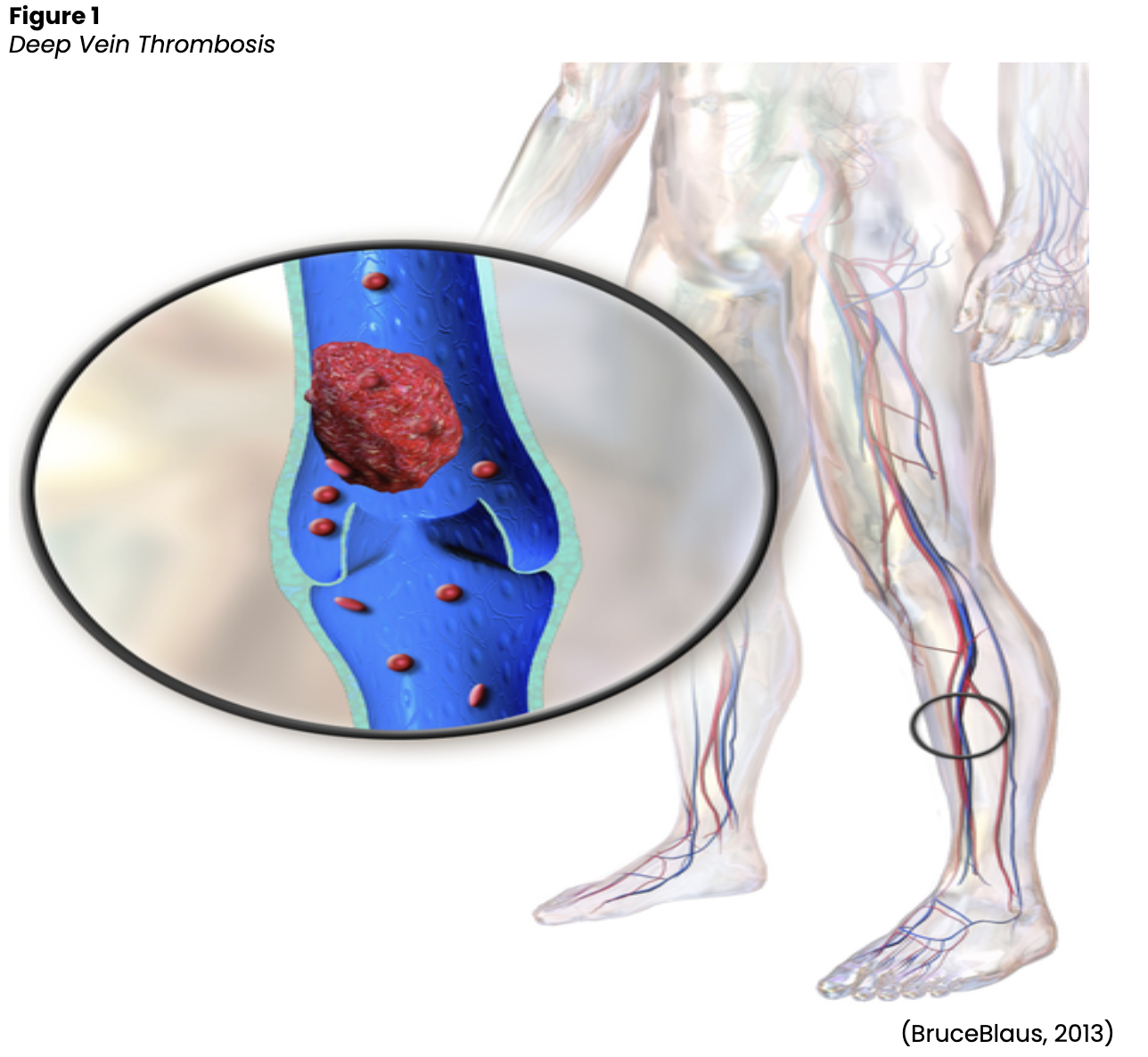 Venous Thromboembolism for RNs and LPNs Nursing CE Course | NursingCE