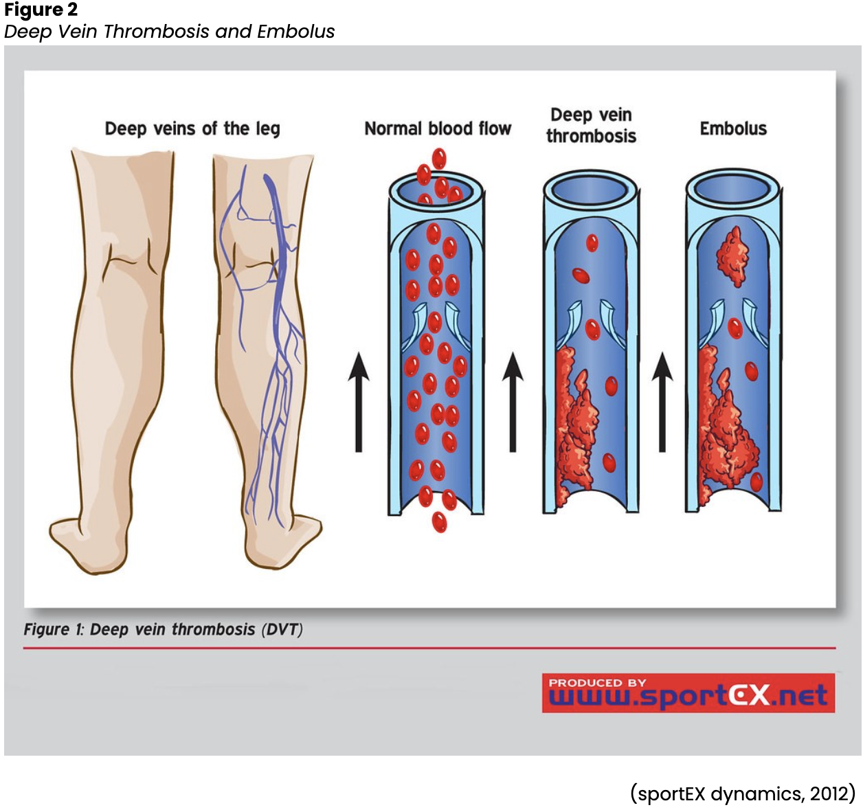 Venous Thromboembolism for RNs and LPNs Nursing CE Course | NursingCE