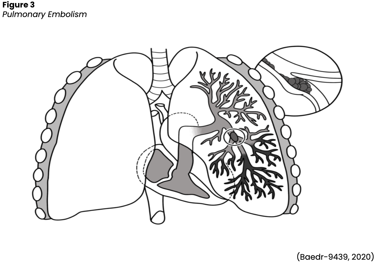 Venous Thromboembolism for RNs and LPNs Nursing CE Course | NursingCE