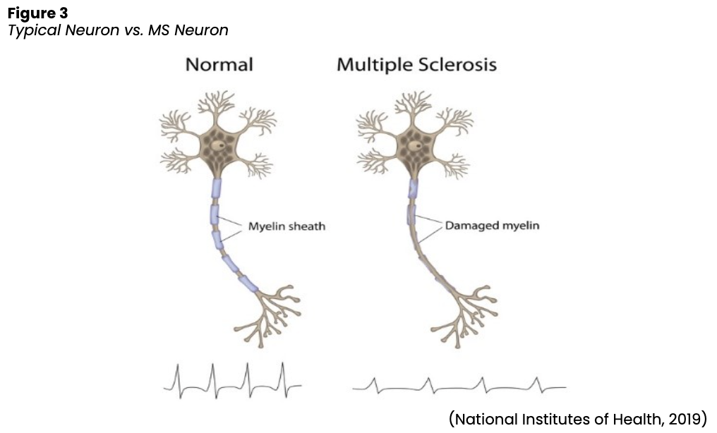 Multiple Sclerosis Neuron