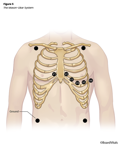 Introduction to Telemetry Monitoring for Arrhythmias Nursing CE Course ...