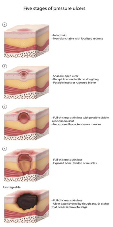 Pressure Ulcer Staging Guide