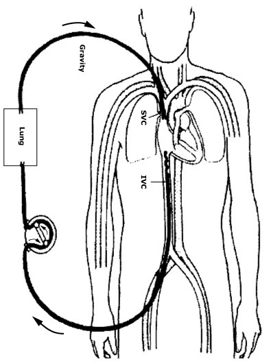Extracorporeal Membrane Oxygenation (ECMO) Nursing CE Course | NursingCE