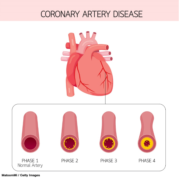 Acute Myocardial Infarction Nursing CE Course for RNs and LPNs | NursingCE