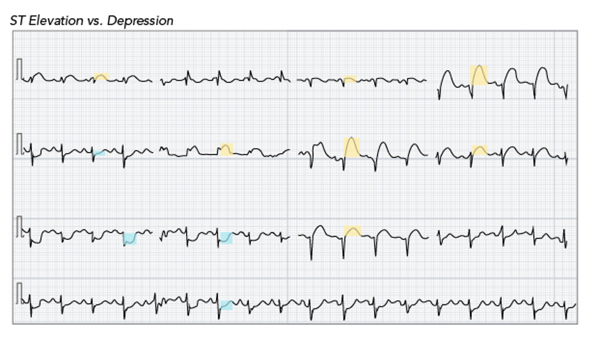 Acute Myocardial Infarction Nursing CE Course for RNs and LPNs | NursingCE