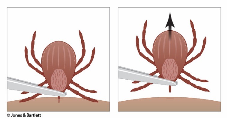 Tickborne Diseases Nursing CE Course for APRNs | NursingCE