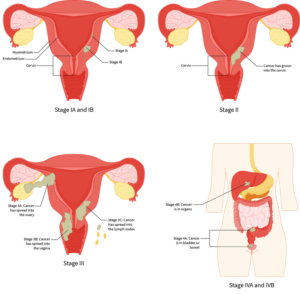 Endometrium Discharge